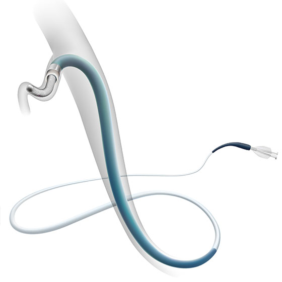 Occlusafe™ Temporary Occlusion Balloon Catheter | TIS Occlusafe™ Temporary Occlusion Balloon Catheter | TIS